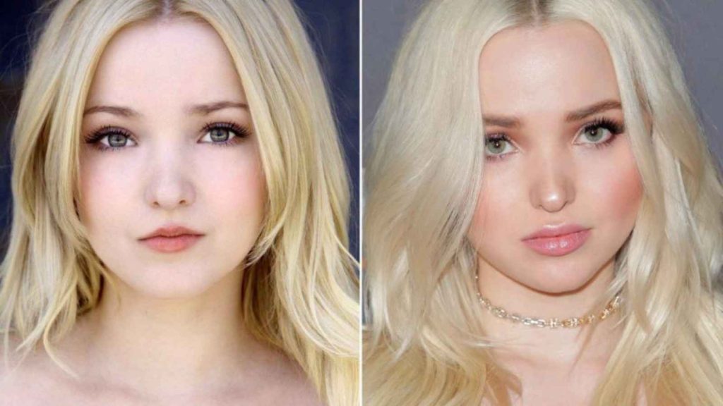 Dove Cameron before and after Plastic Surgery looks - Eduvast.com